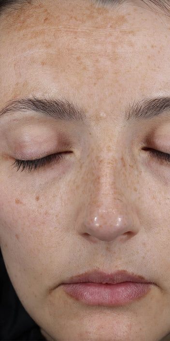 Hyperpigmentation Serum | Treatment for Dark Spots & Uneven Skin Tone ...