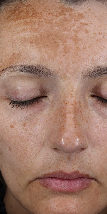 Hyperpigmentation Serum | Treatment for Dark Spots & Uneven Skin Tone ...